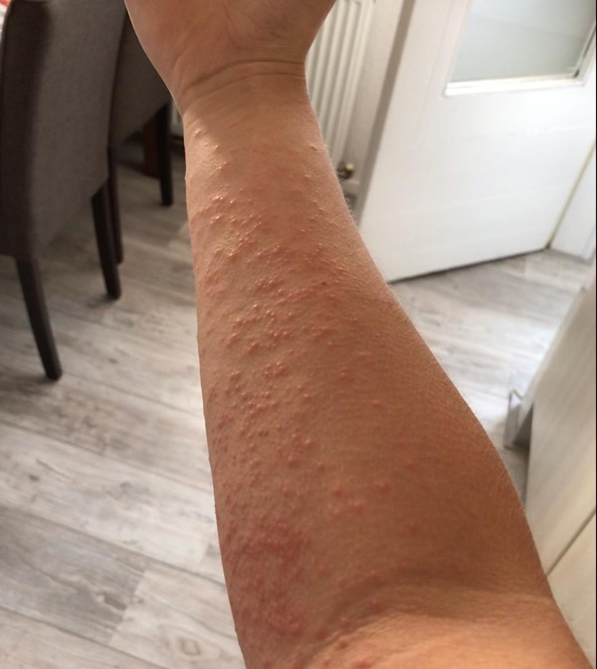 Deze huisarts vertelt wat je tegen jeuk van de processierups kunt doen ...