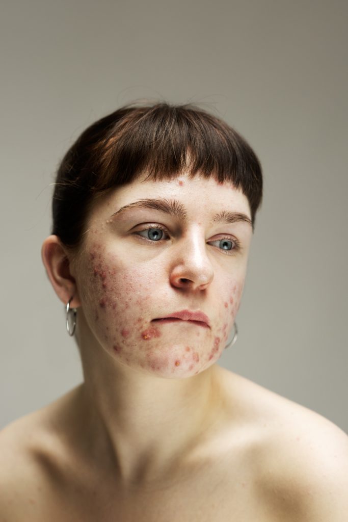 Deze bijzondere serie toont foto's van vrouwen met een huidaandoening ...