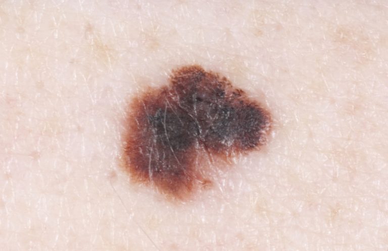 Zó voorkom je huidkanker - LINDA.nl