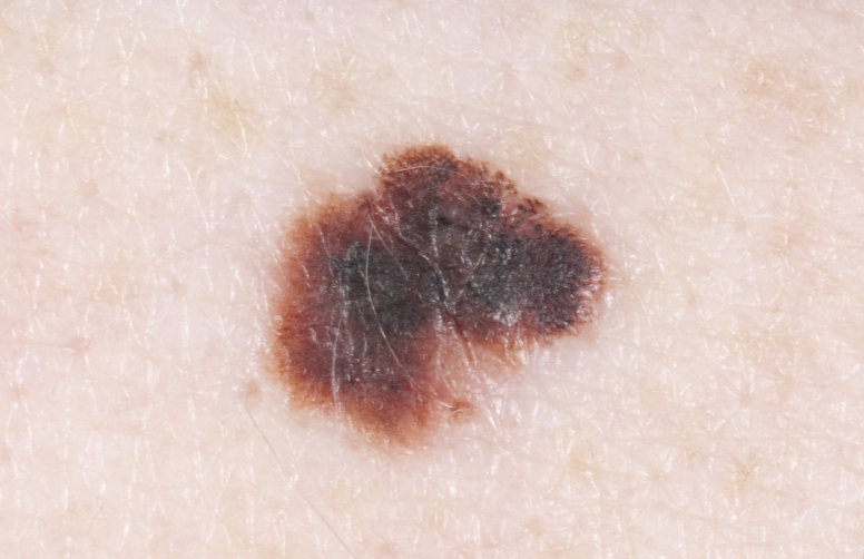 Zó voorkom je huidkanker - LINDA.nl