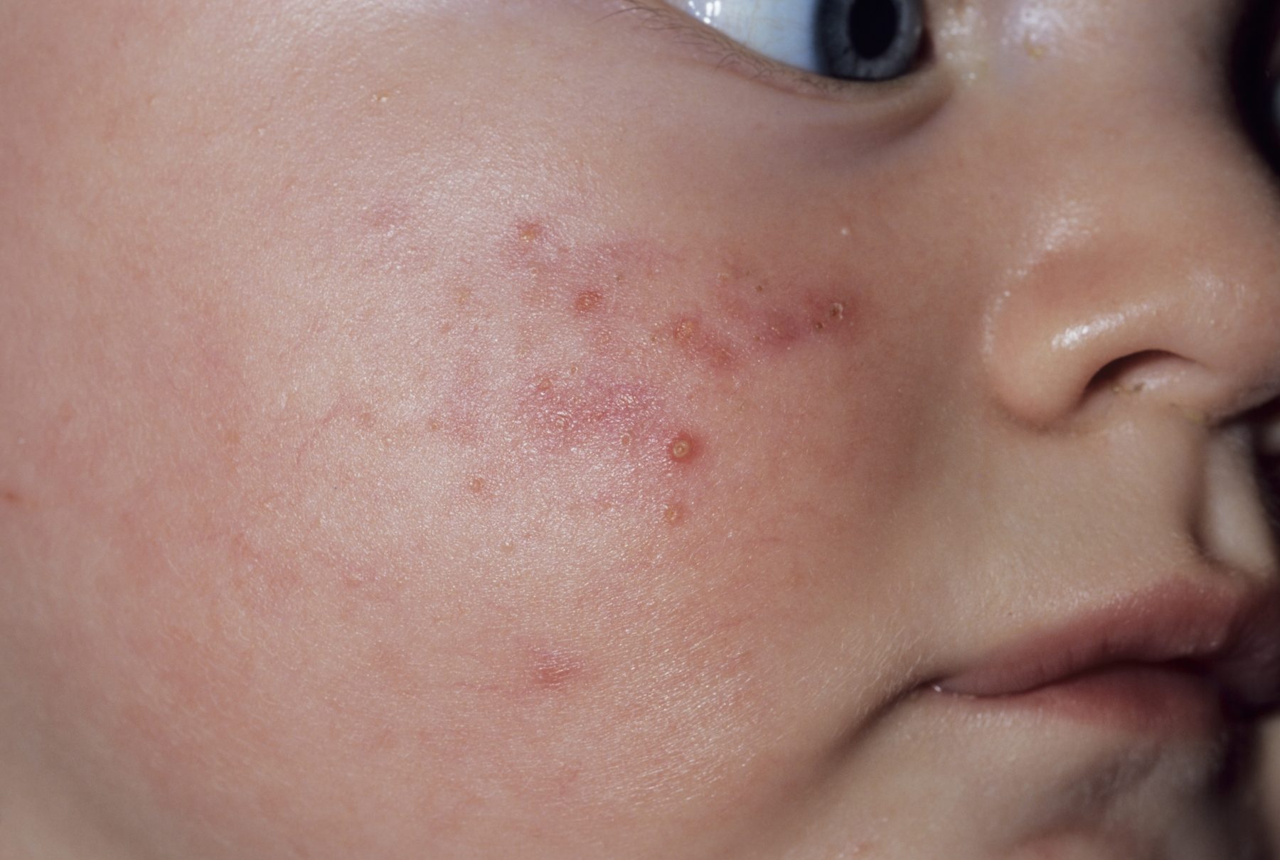 Puistjes, pukkels en mee-eters: dit moet je weten over baby acne - LINDA.nl