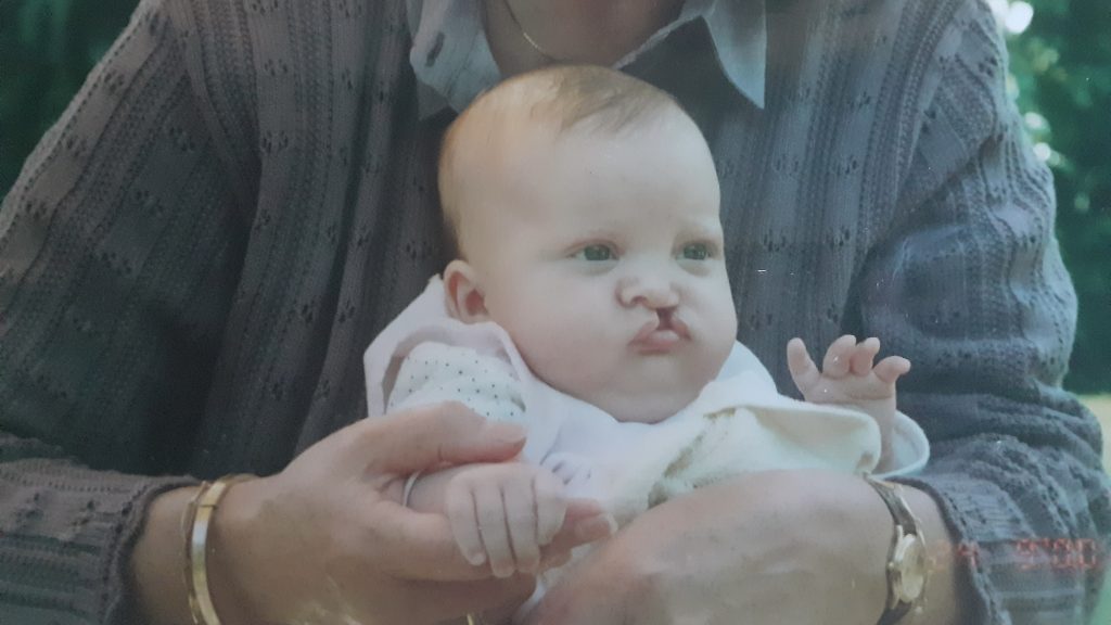 Bibi (22) werd geboren met schisis (een hazenlip): 'Het hoort bij mij' - LINDA.nl