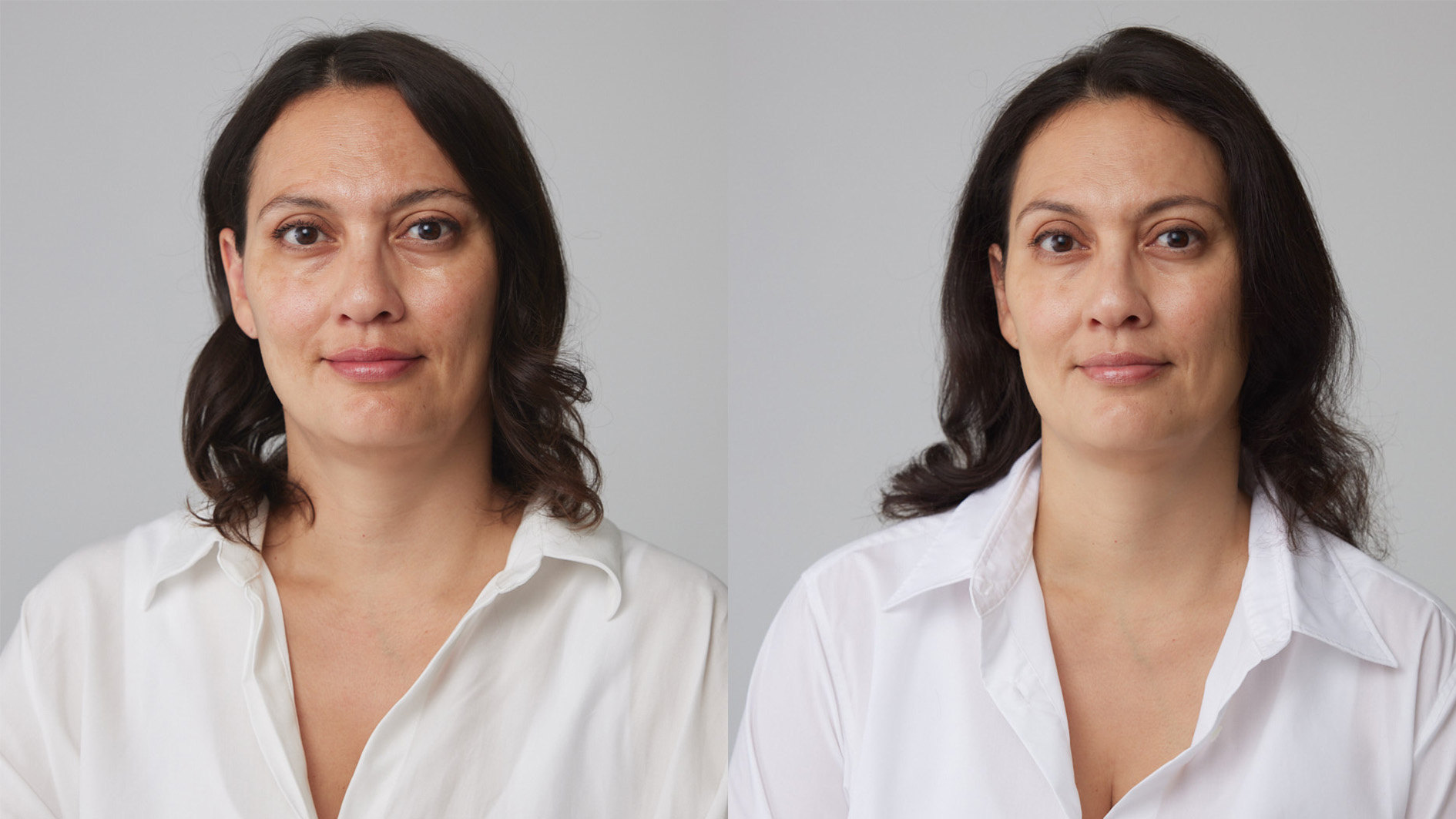 Anne ziet pigmentvlekken verdwijnen door serum - LINDA.nl