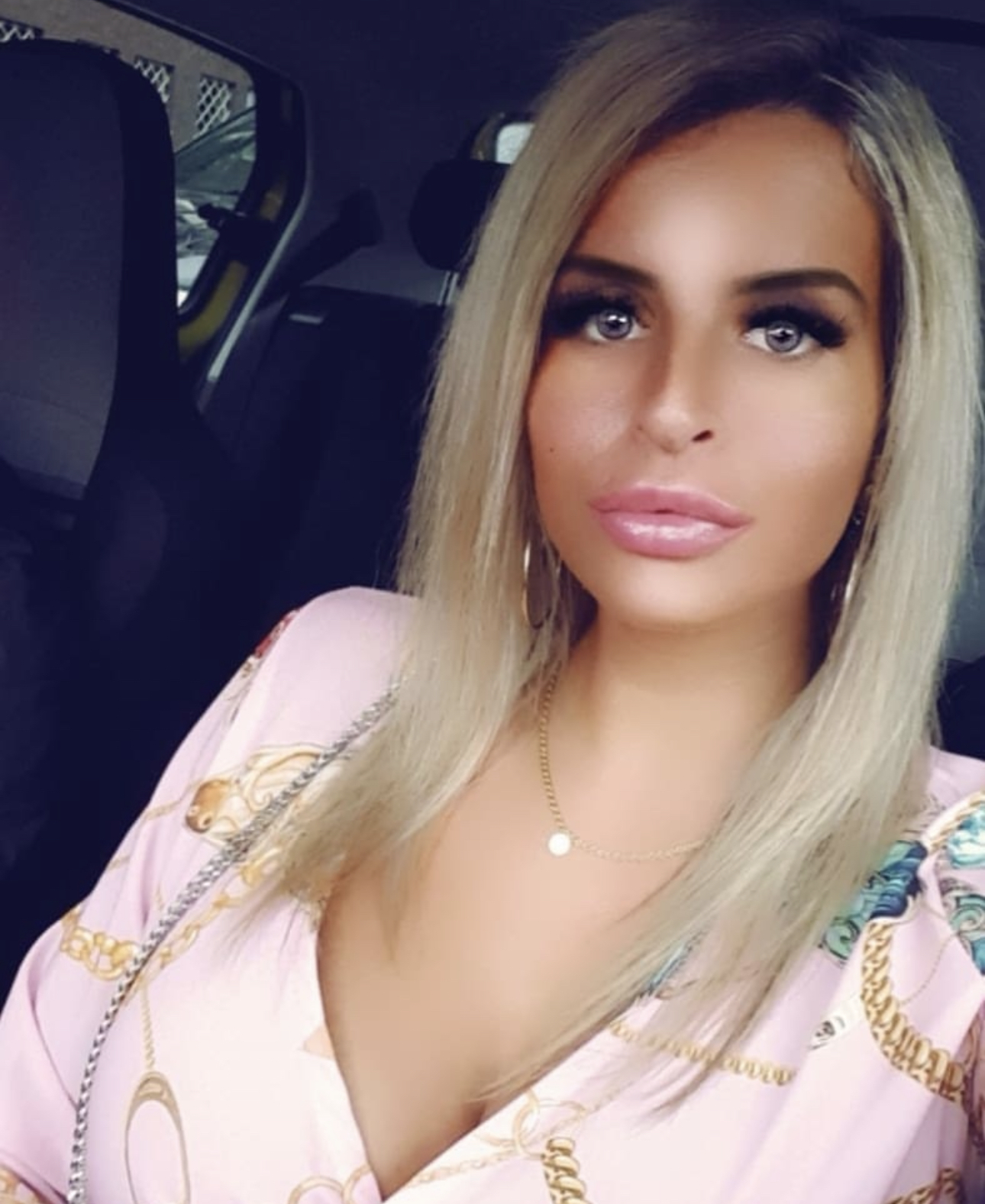 Daniëlle (30) is eerste vrouw ter wereld die neus liet amputeren - LINDA.nl