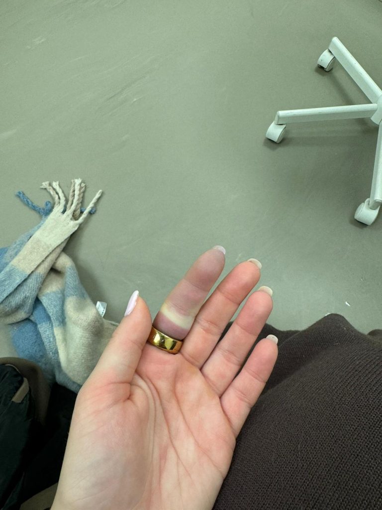Victoria moet knellende Oura Ring laten afzagen: 'Vinger was paars ...